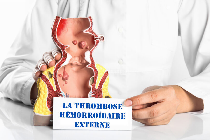 La Thrombose Hémorroïdaire Externe : Comprendre et Traiter – Blog - A ...